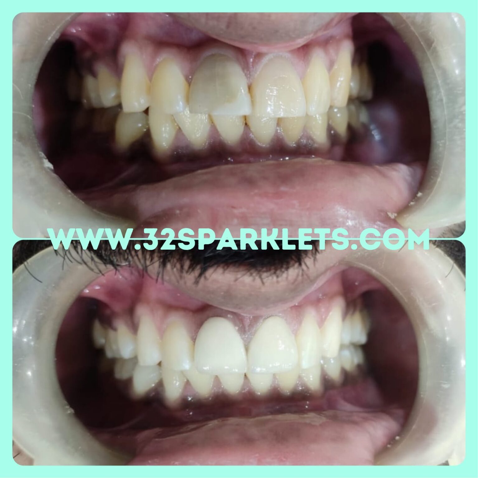 Dental Cleaning (Scaling): Why is it absolutely important? - DentistMaa