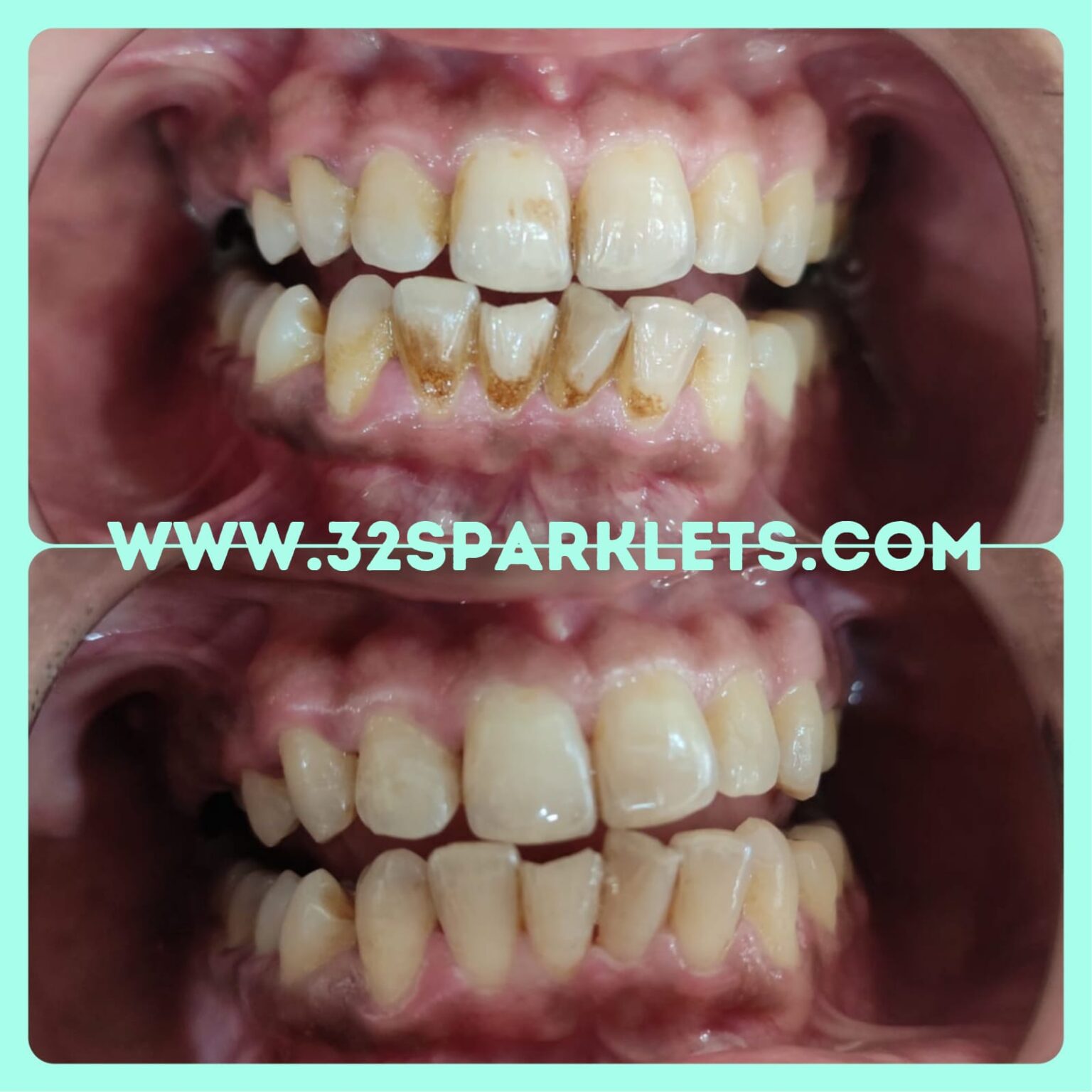 Dental Cleaning (Scaling): Why is it absolutely important? - DentistMaa