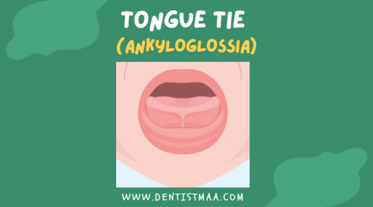 Tongue Tie (Ankyloglossia): All You Need To Know - DentistMaa