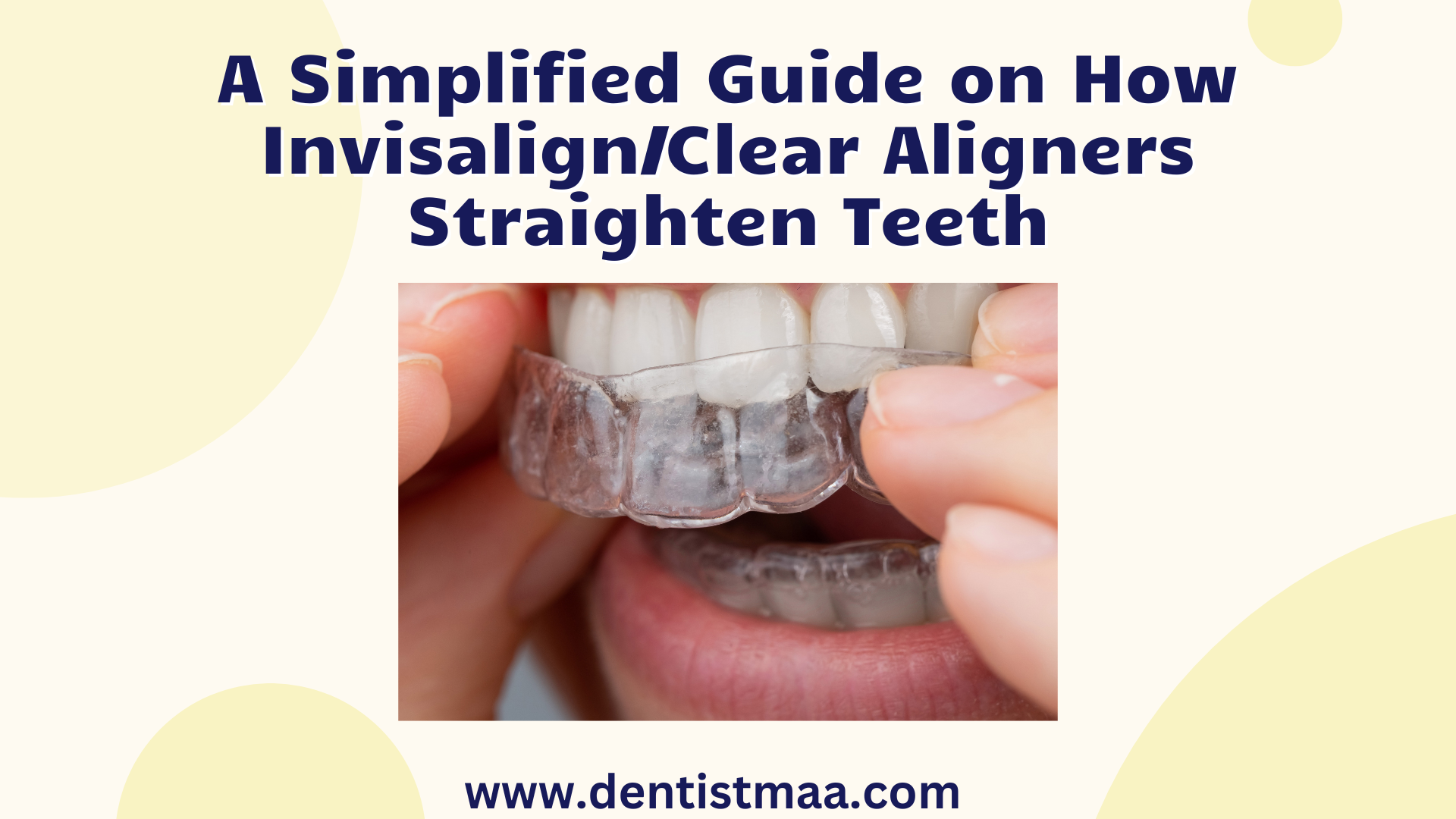 A Simplified Guide On How Invisalign Clear Aligners Straighten Teeth