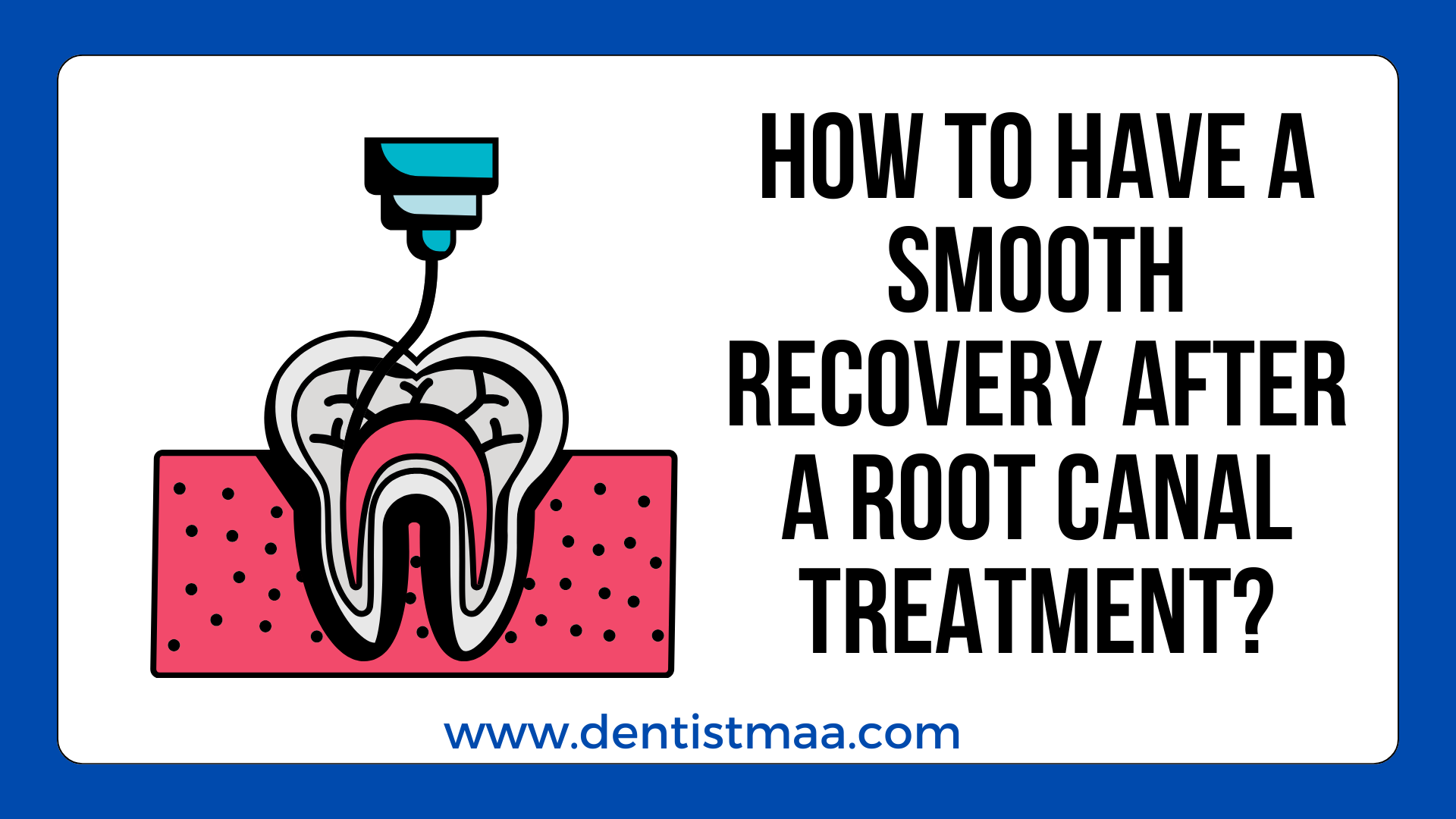 How to have a Smooth Recovery after a Root Canal Treatment? - DentistMaa
